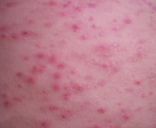 How to Get Rid of Stress Bumps Quickly | Mellowed